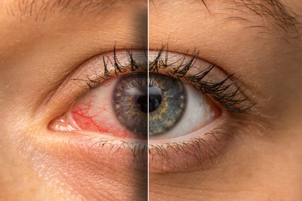 Why Are My Eyes Red Bloodshot Causes And Treatment Ocuwellness Why Are My Eyes Red Bloodshot Causes And Treatment Ocuwellness