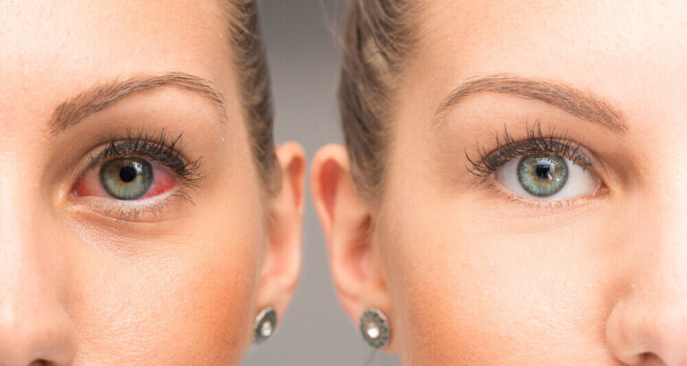 Why Are My Eyes Red & Bloodshot? | Causes and Treatment | Ocuwellness