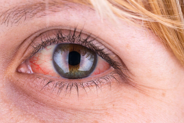 Why Are My Eyes Red & Bloodshot? | Causes and Treatment | Ocuwellness